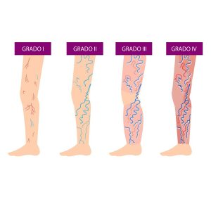 Diferentes grados de las varices, ¿cuál es el tuyo? ¡Descúbrelo!
