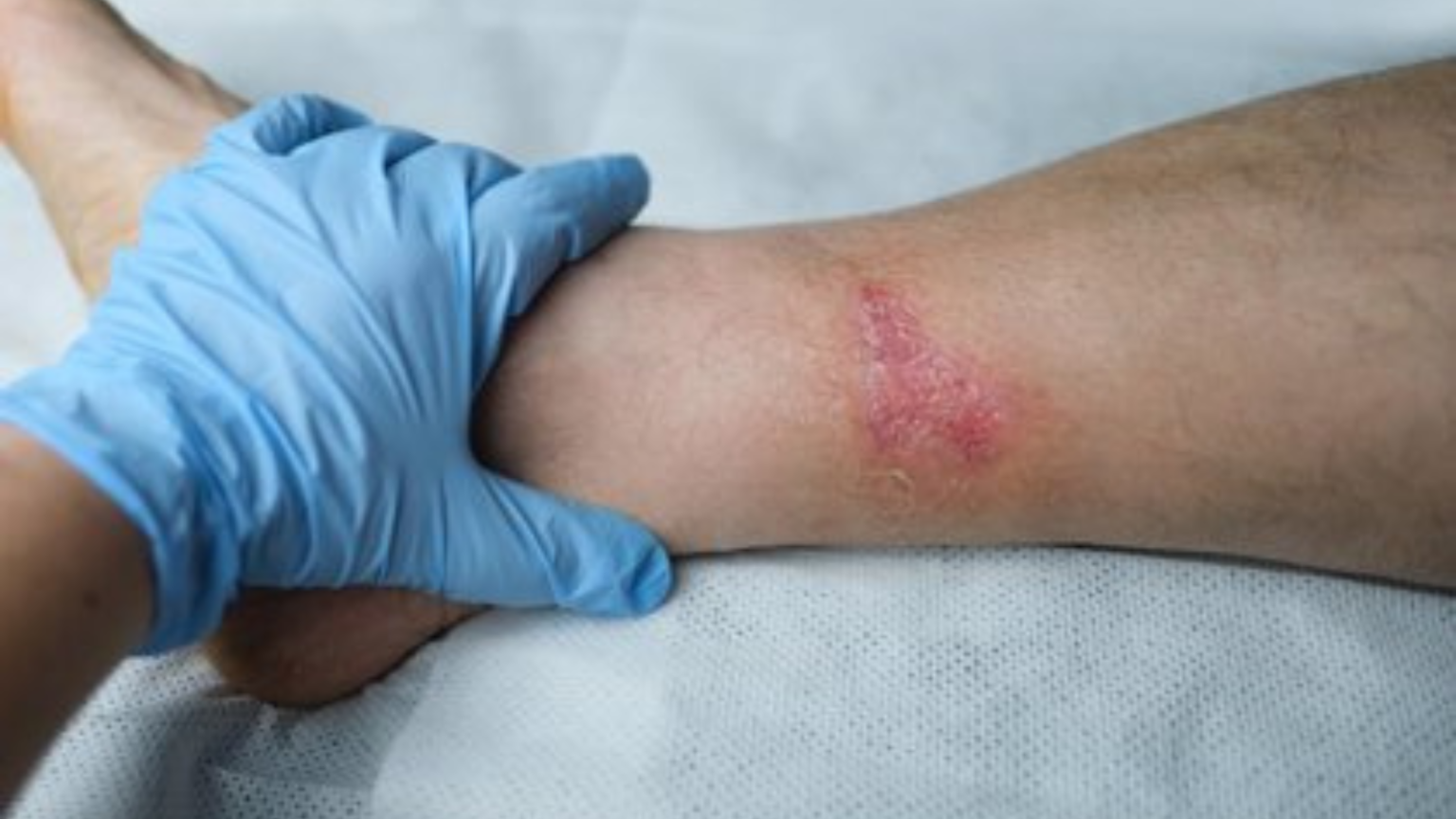 Cómo curar úlceras en las piernas