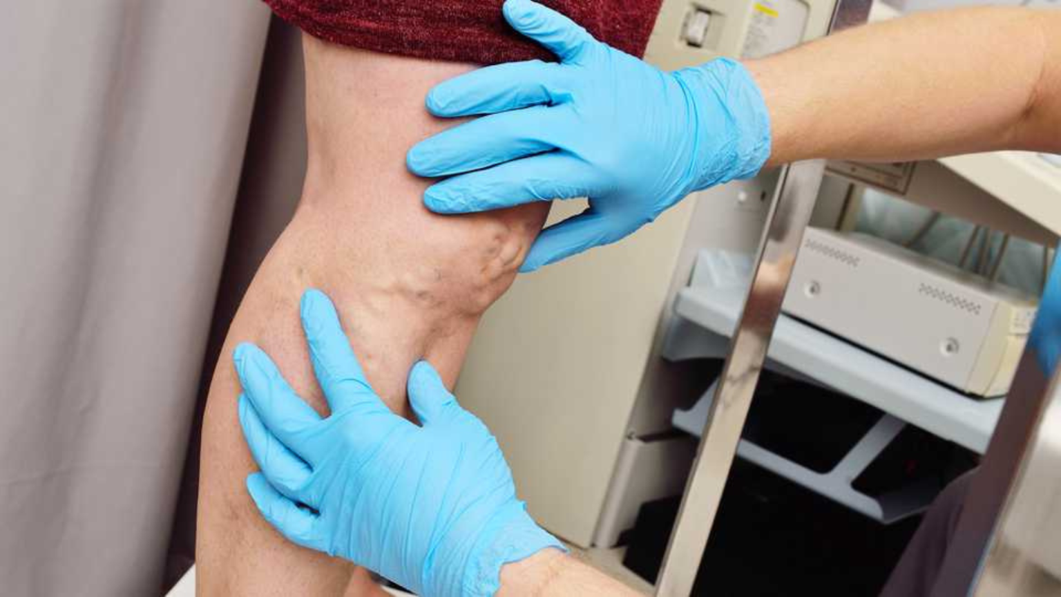 Conoce todo sobre las venas reticulares