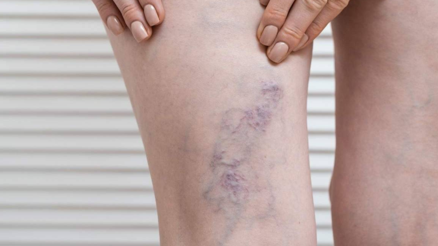 Úlcera arterial vs úlcera venosa, ¿en qué se diferencian?